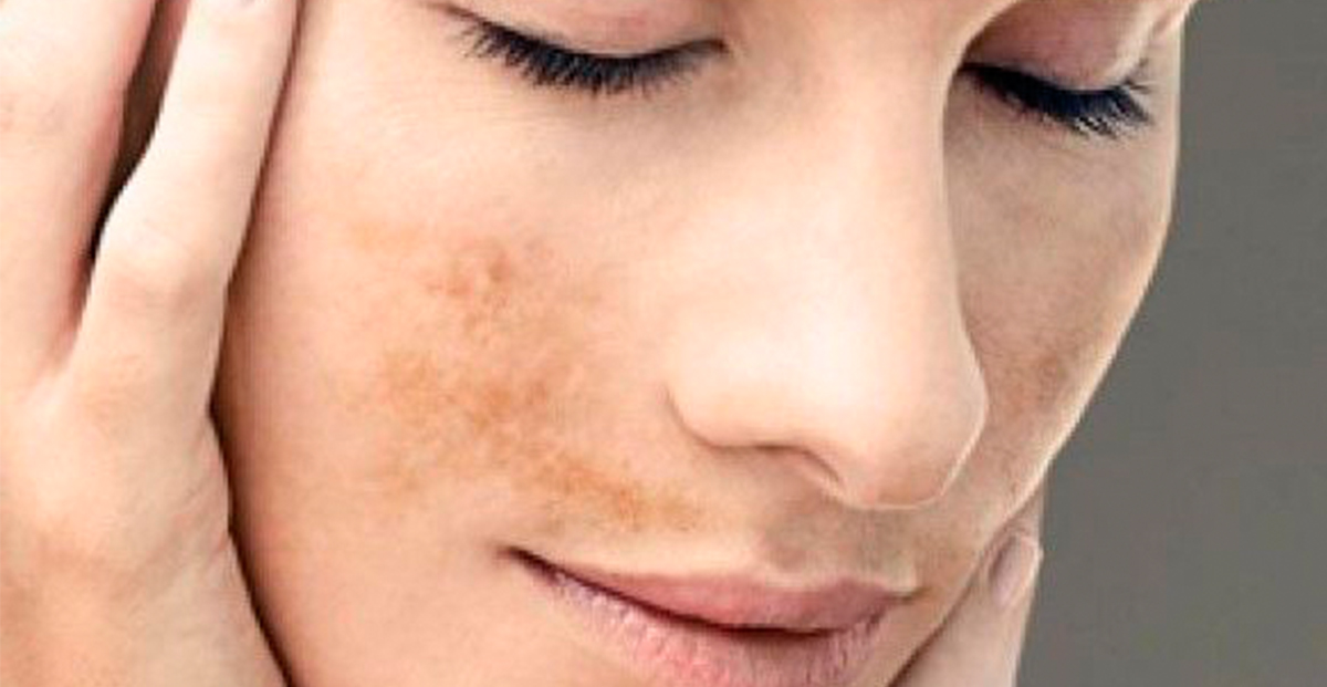 Manchas en la piel: por qué se producen y cómo mejorar su aspecto ...