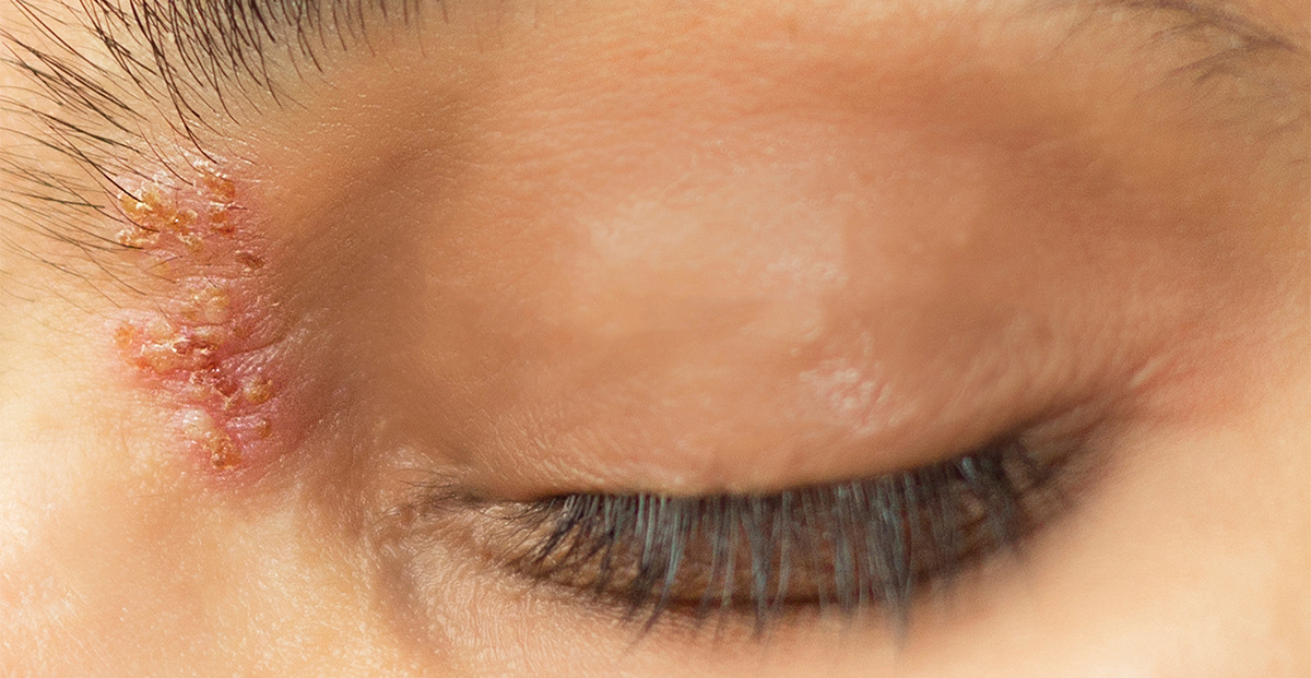 Herpes Zóster (o "Culebrilla"): todo lo que tenés que saber sobre este ...