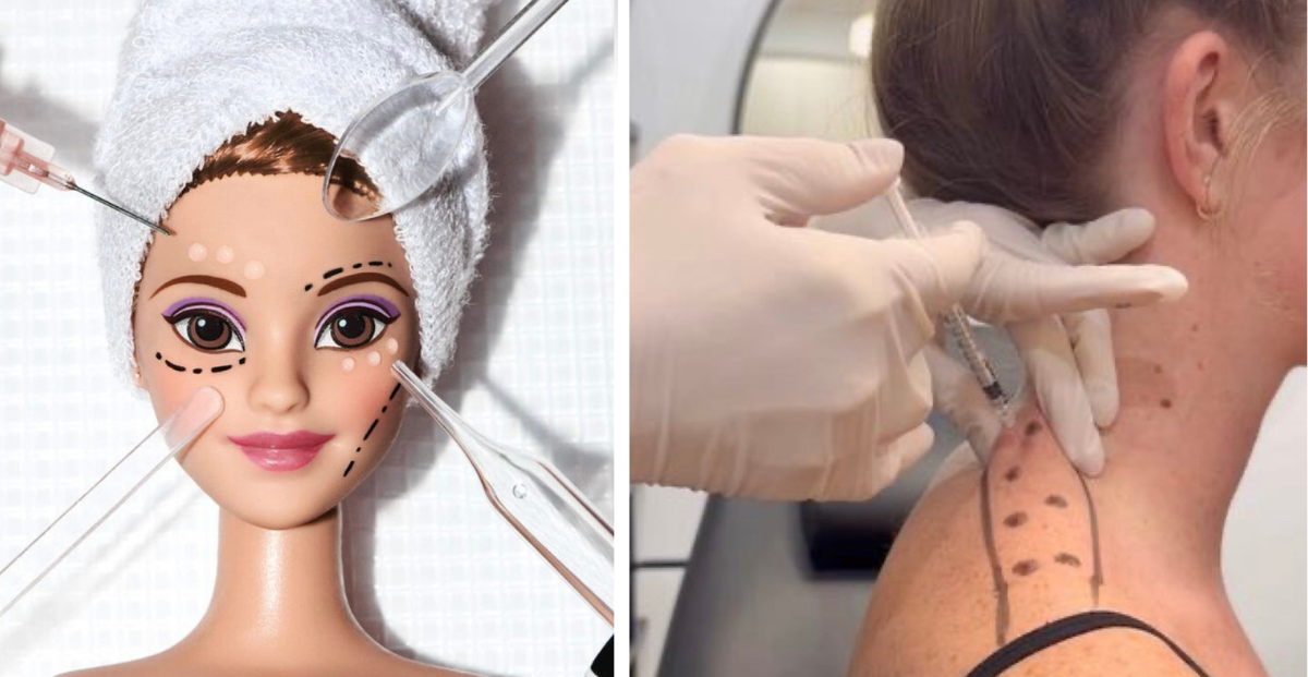 Qué es el Barbie Botox, el retoque que es viral en TikTok - Revista Para Ti