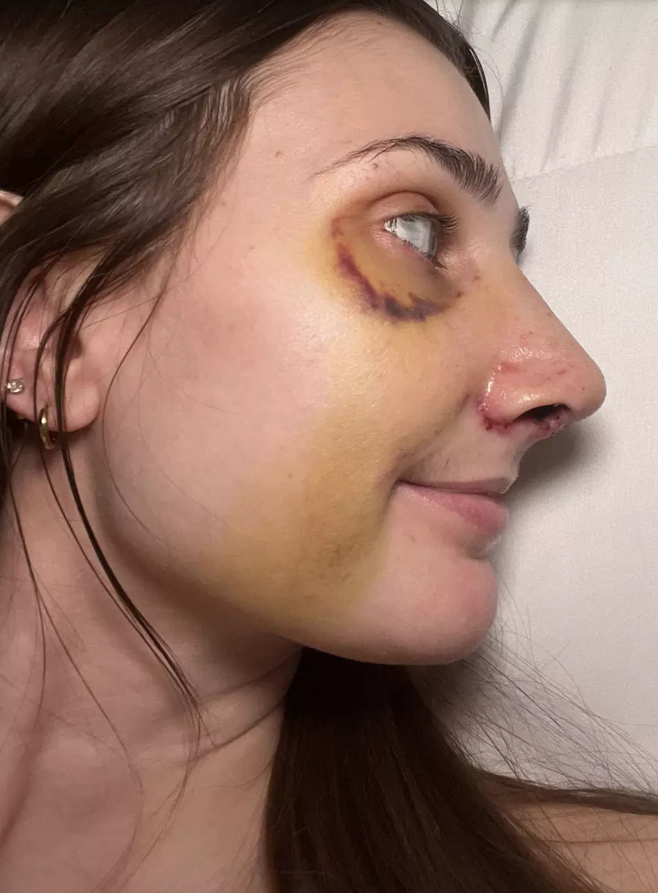 Una cirugía de nariz le cambió la vida y la ayudó a reencontrarse con su identidad